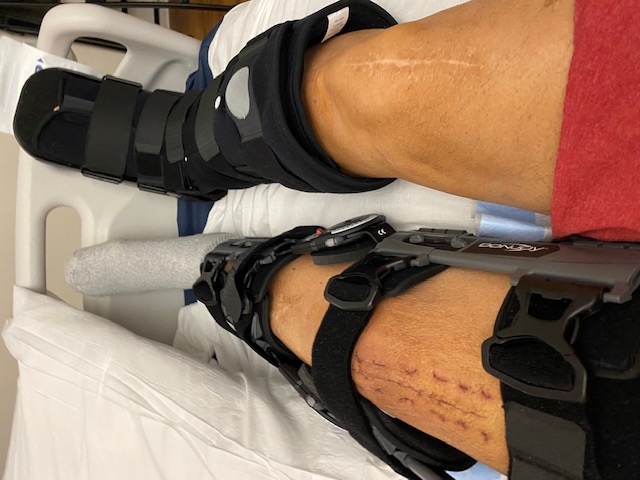 Lessons I learned over the summer when I had no leg to stand on ...